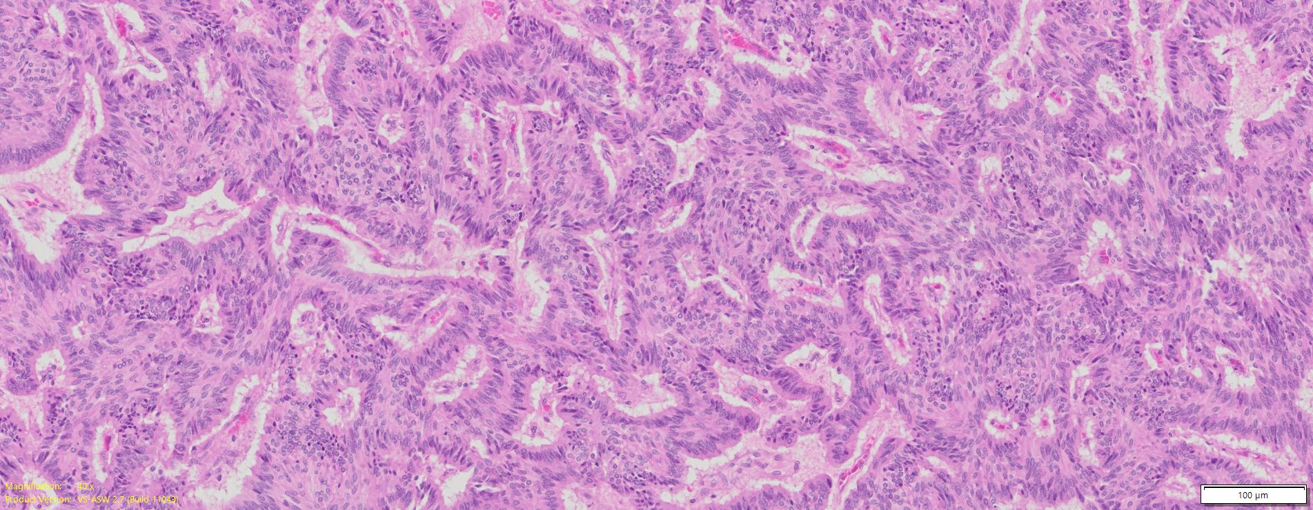 Human Ovary Cancer (Teratoma and neuroendocrine tumor) FFPE Sections