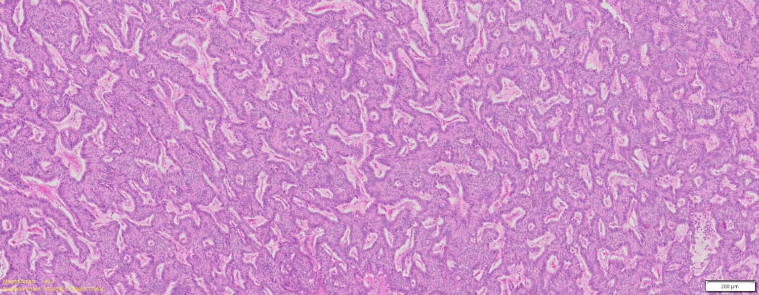 Human Ovary Cancer (Teratoma and neuroendocrine tumor) FFPE Sections