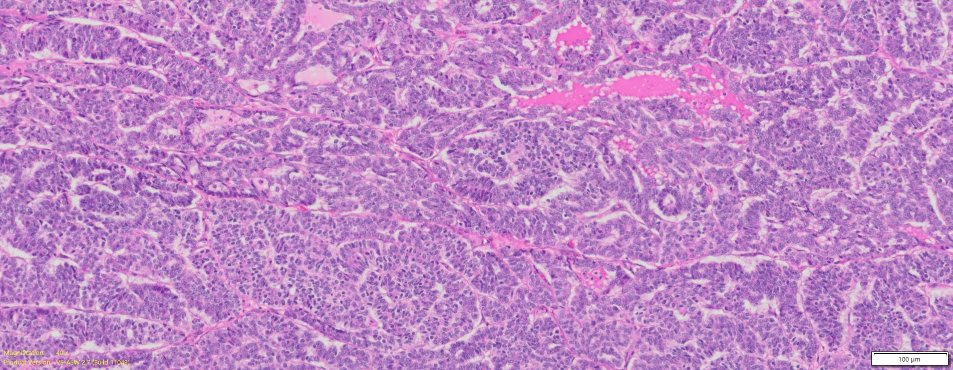 Human Ovary Cancer (Serous cyst adenocarcinoma) FFPE Sections
