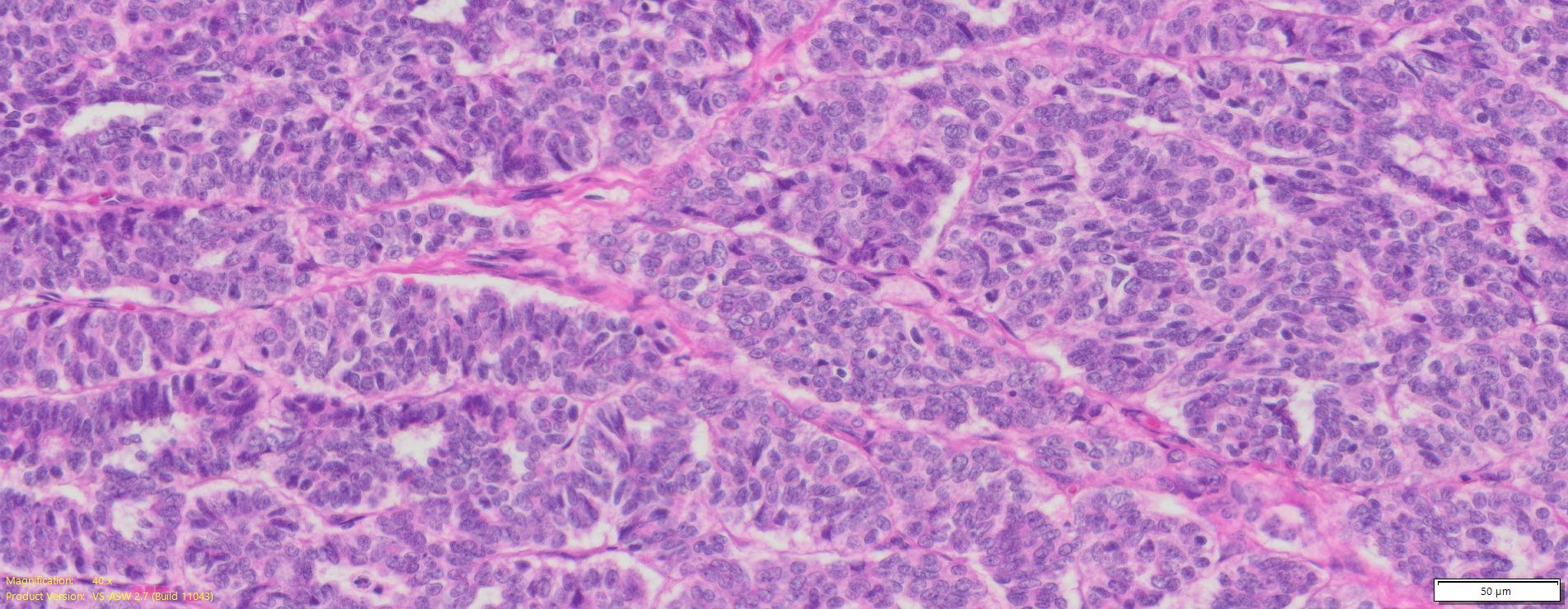 Human Ovary Cancer (Serous cyst adenocarcinoma) FFPE Sections Human Ovary Cancer (Serous cyst adenocarcinoma) FFPE Sections
