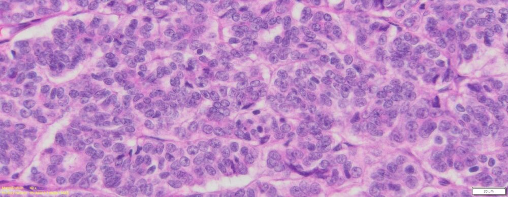 Human Ovary Cancer (Serous cyst adenocarcinoma) FFPE Sections