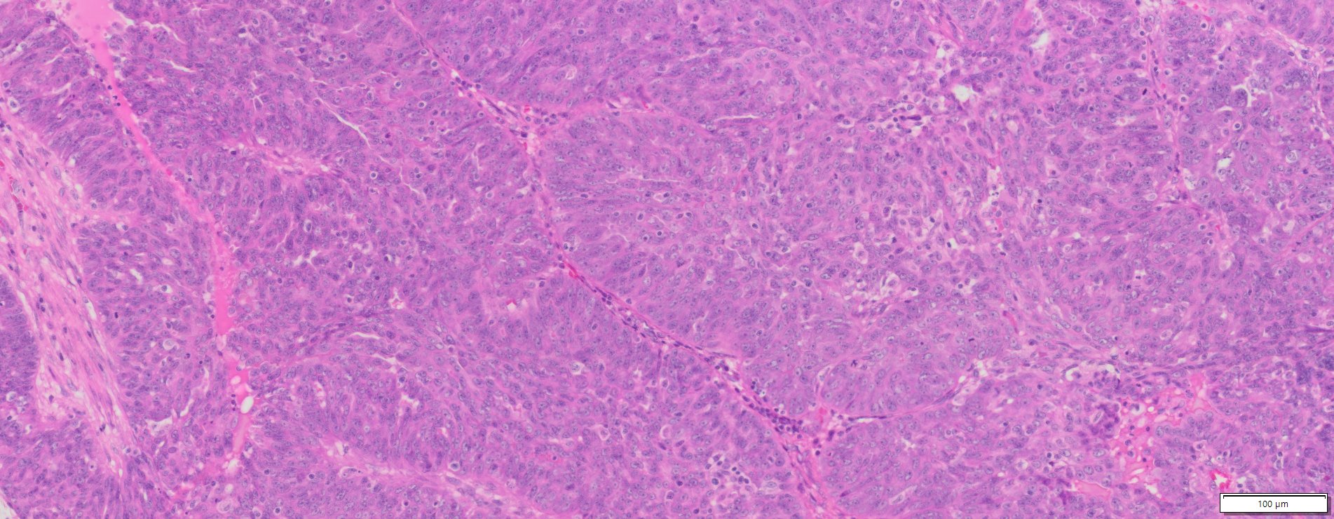 Human Ovary Cancer (Serous cyst adenocarcinoma) FFPE Sections