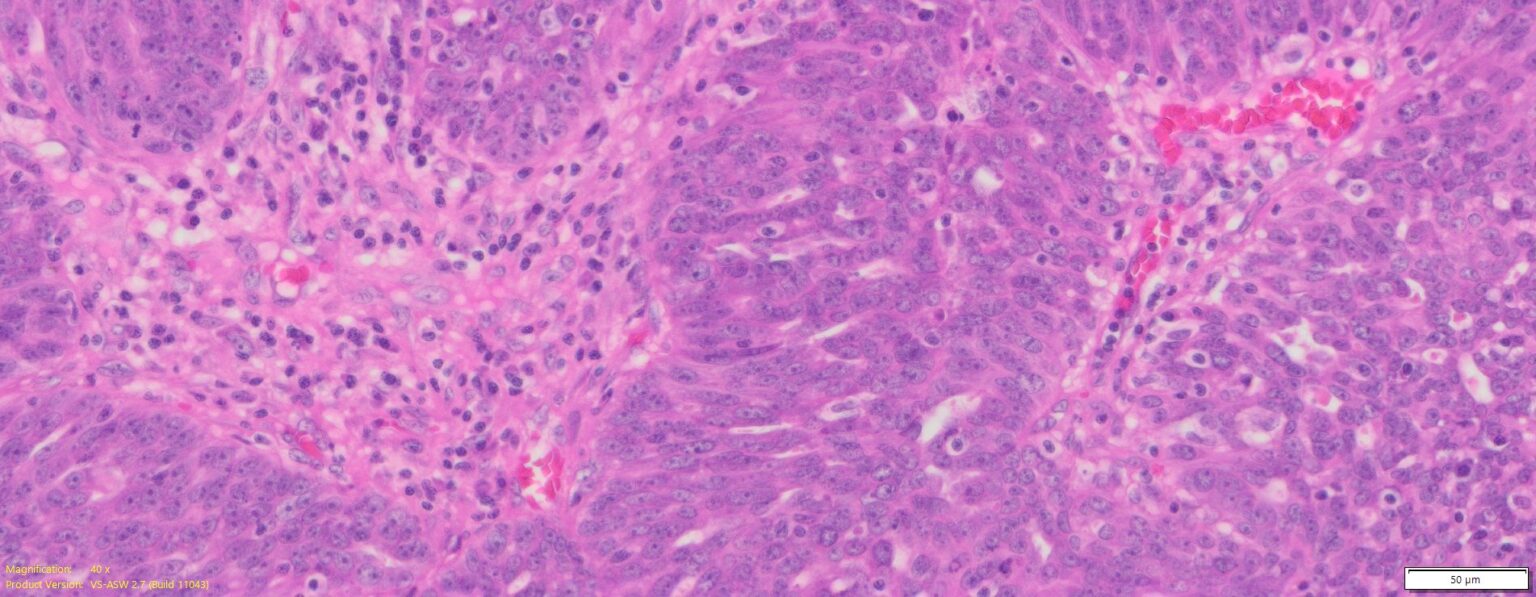 Human Ovary Cancer (Serous cyst adenocarcinoma) FFPE Sections
