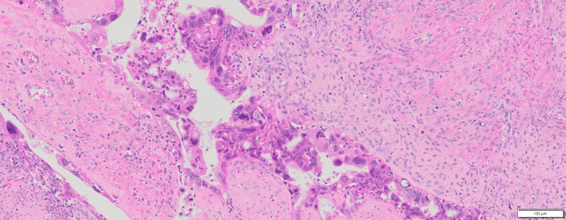 Human Ovary Cancer (Serous cyst adenocarcinoma) FFPE Sections