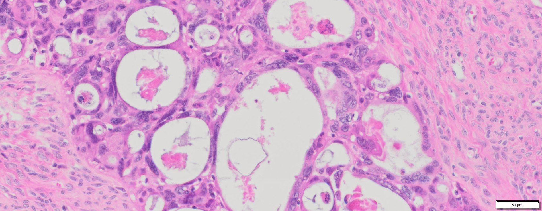 Human Ovary Cancer (Serous cyst adenocarcinoma) FFPE Sections