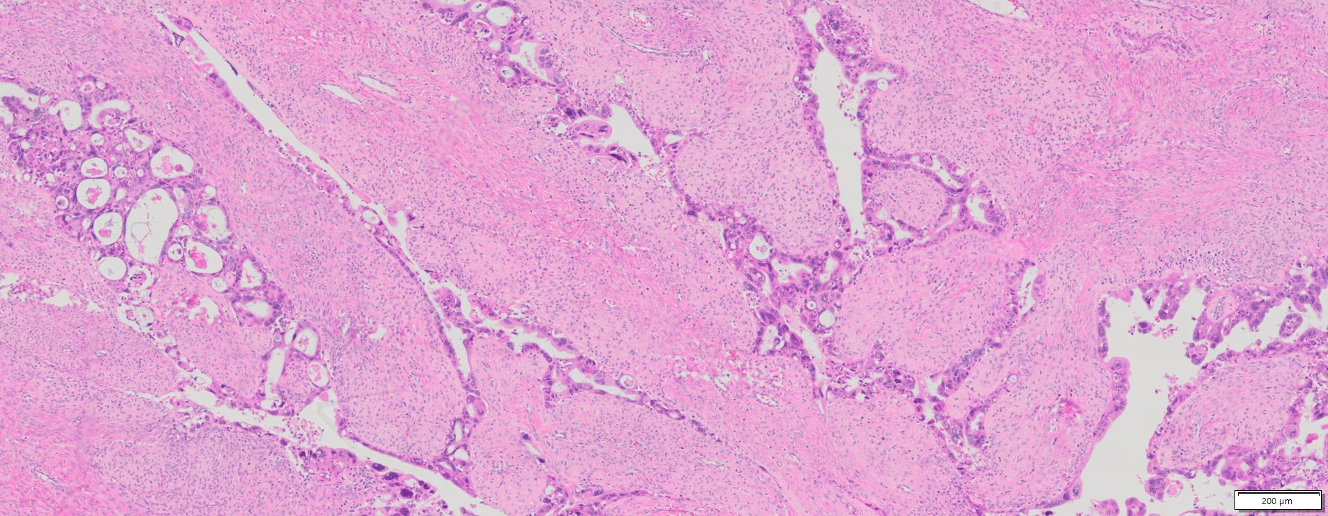 Human Ovary Cancer (Serous cyst adenocarcinoma) FFPE Sections
