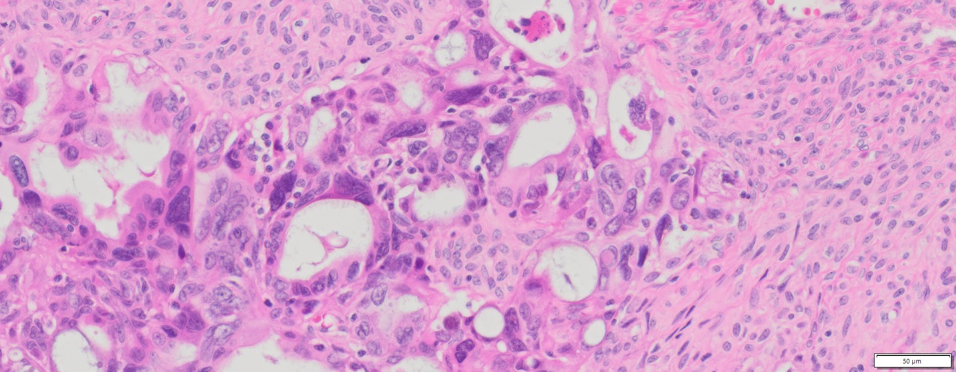 Human Ovary Cancer (Serous cyst adenocarcinoma) FFPE Sections