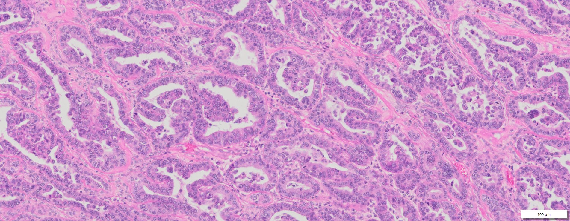 Human Ovary Cancer (Serous cyst adenocarcinoma) FFPE Sections Human Ovary Cancer (Serous cyst adenocarcinoma) FFPE Sections