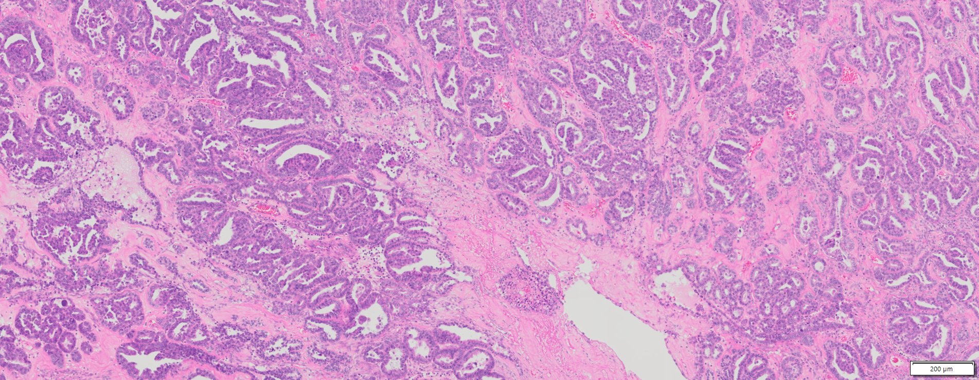 Human Ovary Cancer (Serous cyst adenocarcinoma) FFPE Sections Human Ovary Cancer (Serous cyst adenocarcinoma) FFPE Sections