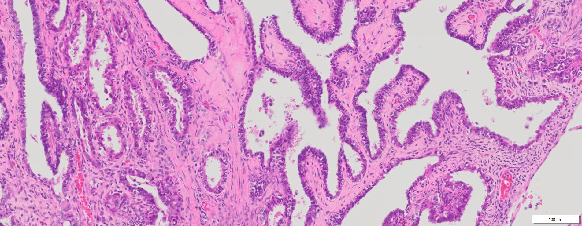 Human Ovary Cancer (Serous cyst adenocarcinoma) FFPE Sections
