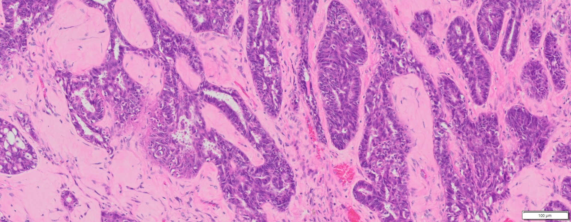Human Ovary Cancer (Serous cyst adenocarcinoma) FFPE Sections