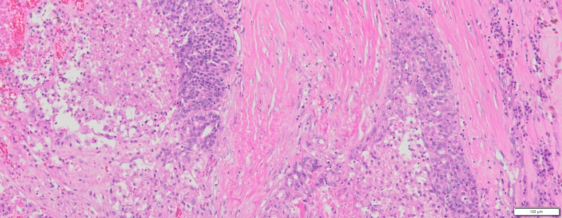 Human Ovary Cancer (Serous cyst Adenocarcinoma) FFPE Sections