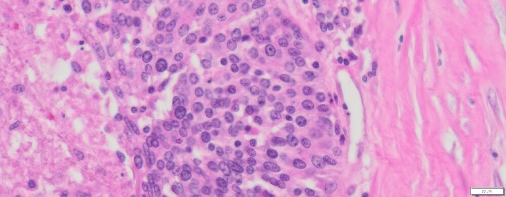 Human Ovary Cancer (Serous cyst Adenocarcinoma) FFPE Sections