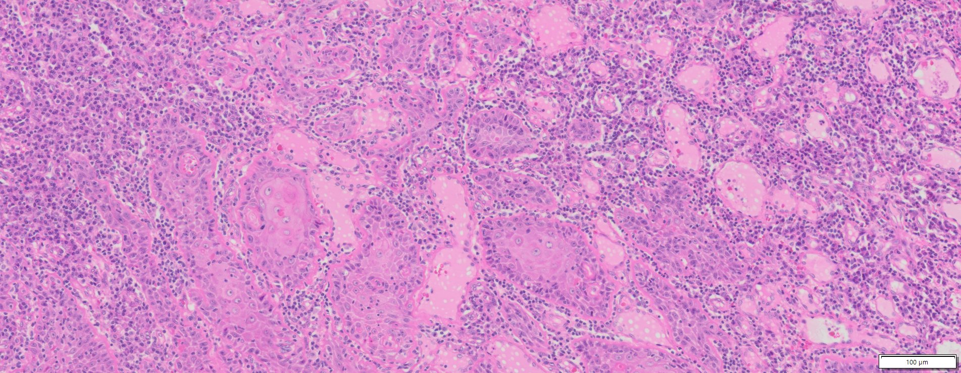 Human hard palate Cancer (Squamous cell carcinoma) FFPE Sections