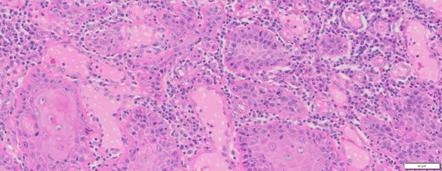Human hard palate Cancer (Squamous cell carcinoma) FFPE Sections