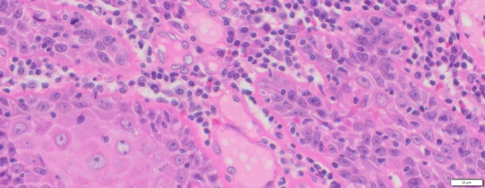 Human hard palate Cancer (Squamous cell carcinoma) FFPE Sections