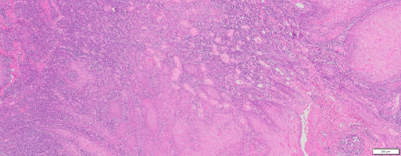 Human hard palate Cancer (Squamous cell carcinoma) FFPE Sections