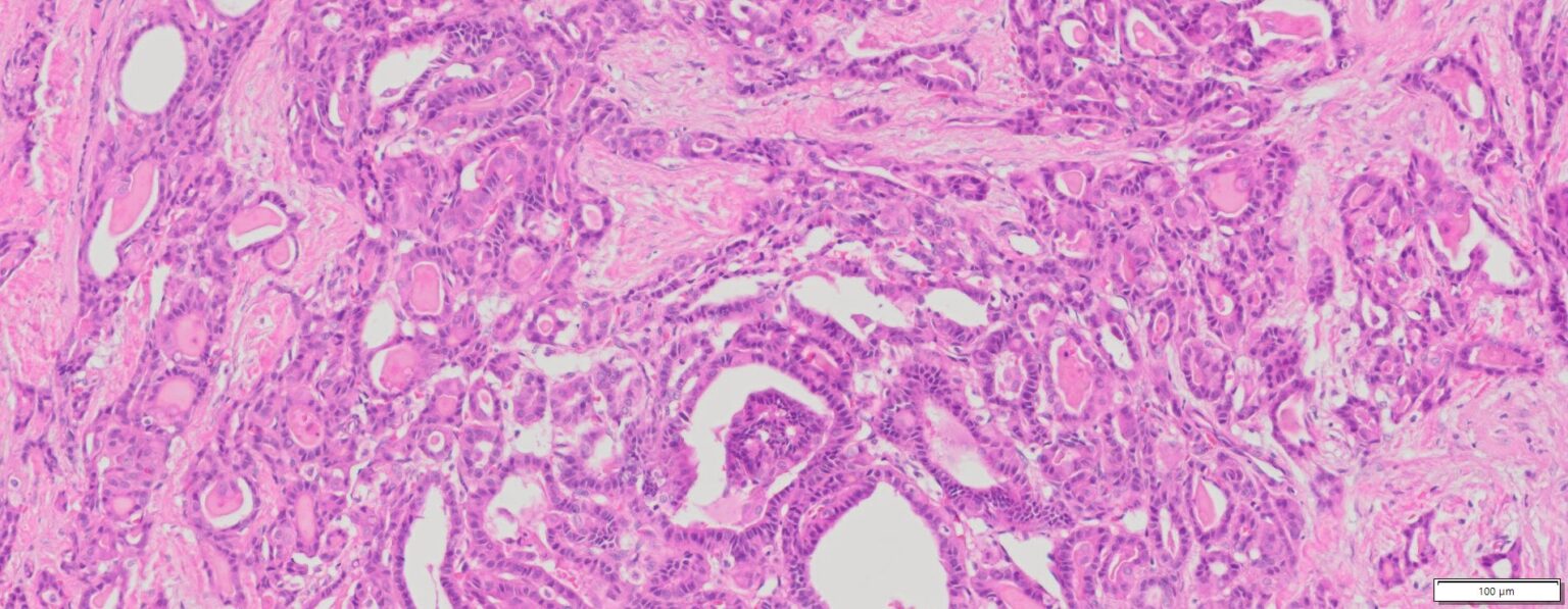 Human Thyroid (Follicular Cancer) FFPE Sections