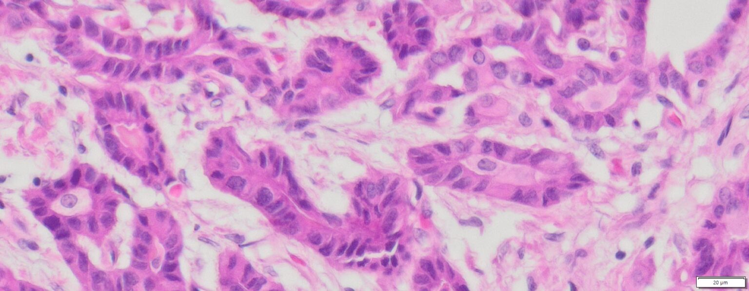 Human Thyroid (Follicular Cancer) FFPE Sections