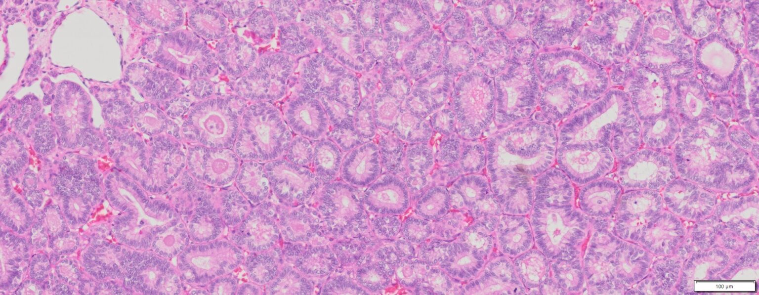 Human Thyroid (Follicular Cancer) FFPE Sections