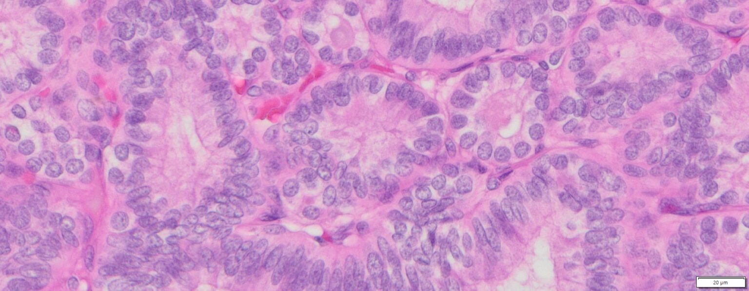 Human Thyroid (Follicular Cancer) FFPE Sections