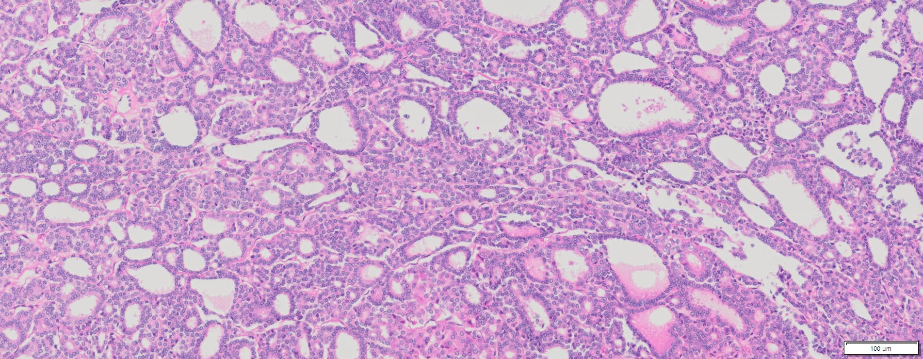 Human Thyroid (Follicular Cancer) FFPE Sections