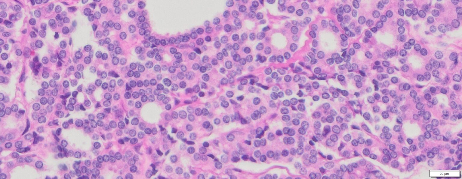 Human Thyroid (Follicular Cancer) FFPE Sections