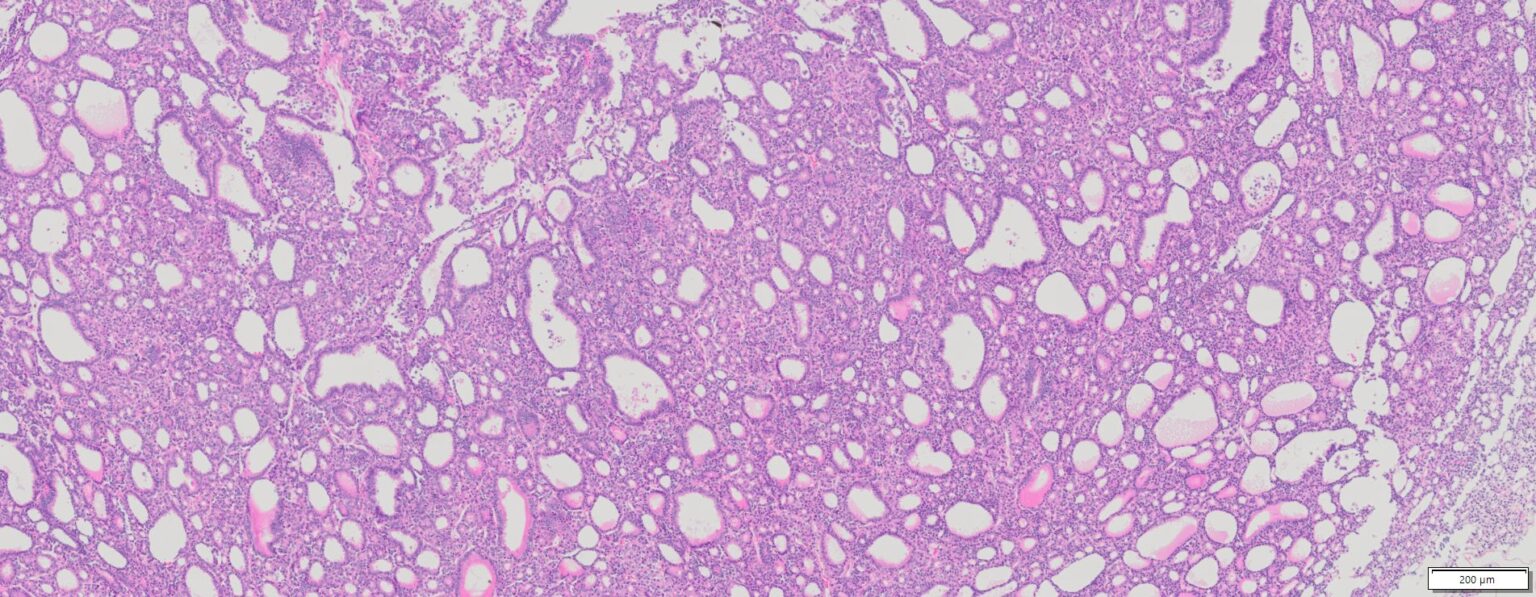 Human Thyroid (Follicular Cancer) FFPE Sections