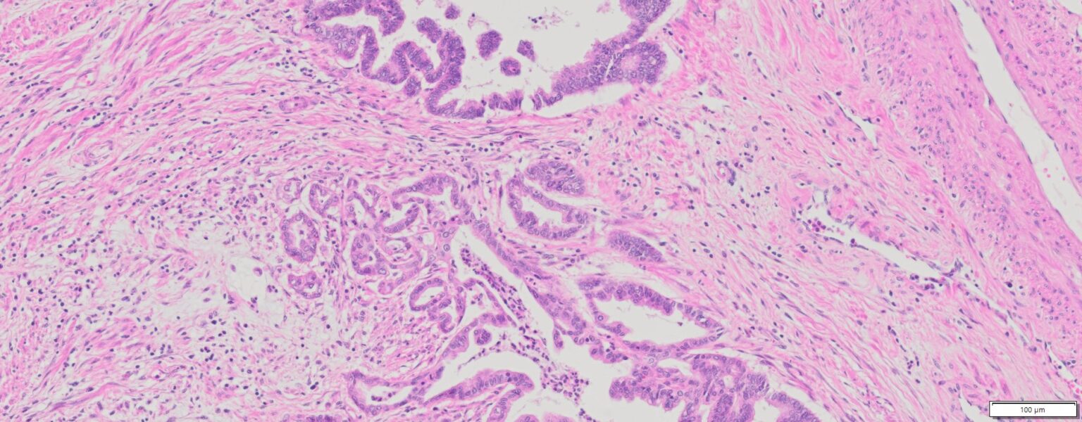 Human Cervical Cancer (Adenocarcinoma) FFPE Sections