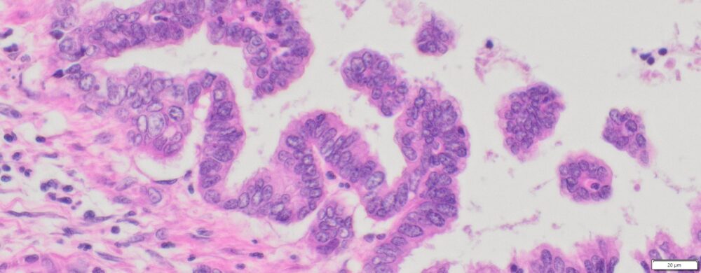 Human Cervical Cancer (Adenocarcinoma) FFPE Sections