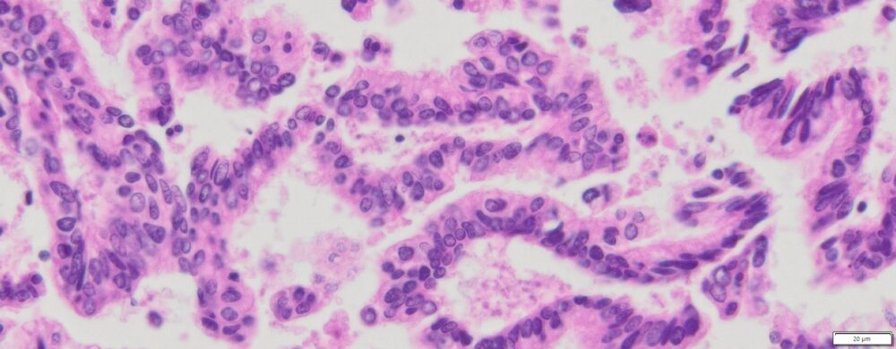 Human Cervical Cancer (Adenocarcinoma) FFPE Sections