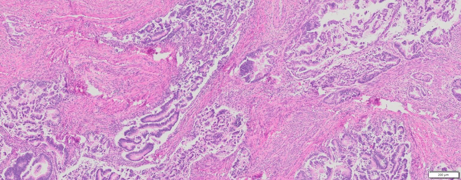 Human Cervical Cancer (Adenocarcinoma) FFPE Sections