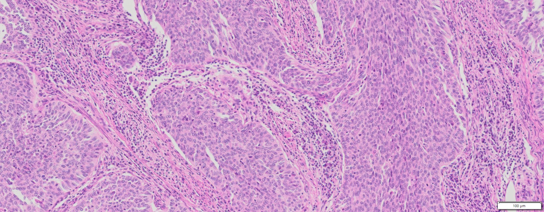 Human Cervical (Squamous Cell Carcinoma) FFPE Sections