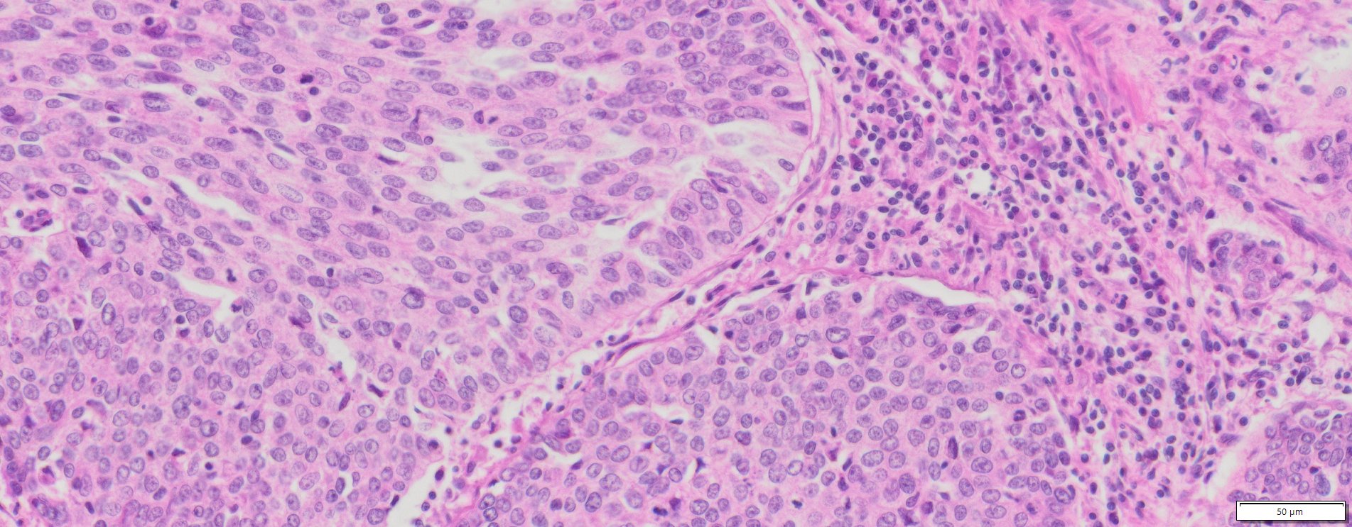 Human Cervical (Squamous Cell Carcinoma) FFPE Sections