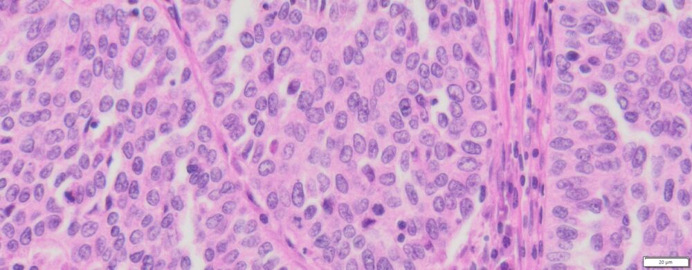 Human Cervical (Squamous Cell Carcinoma) FFPE Sections