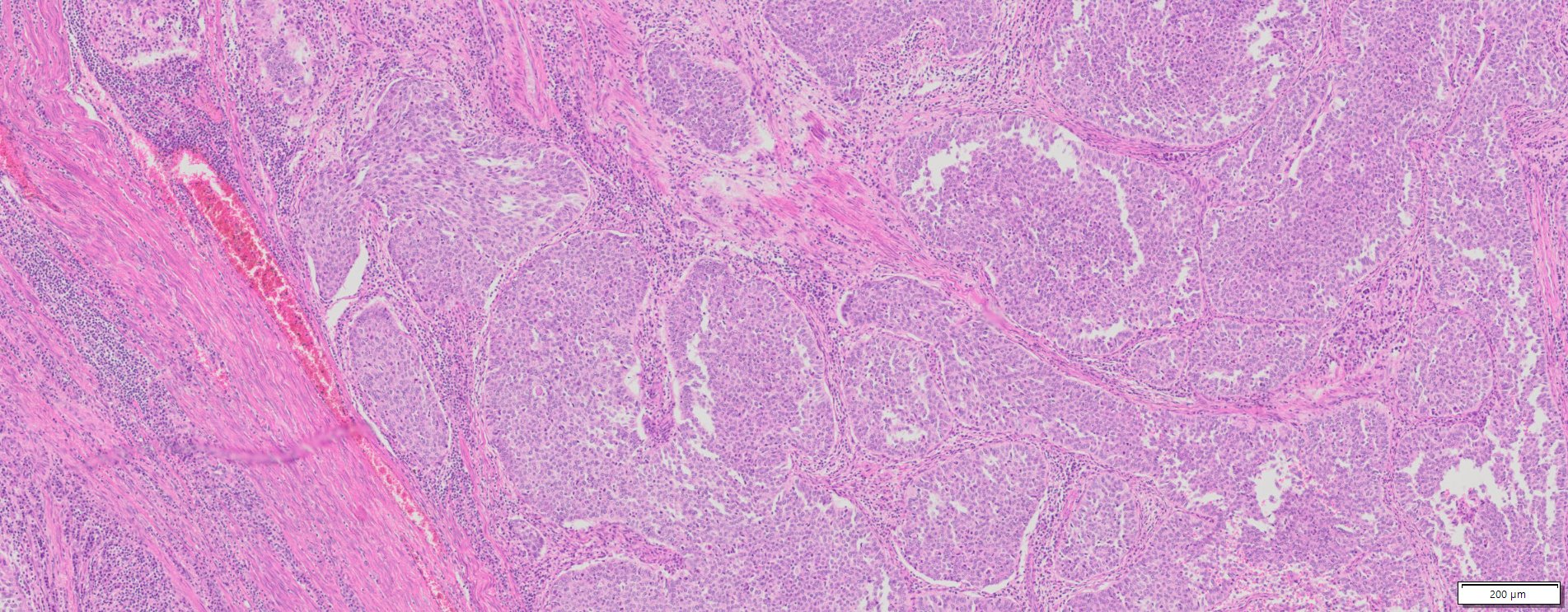 Human Cervical (Squamous Cell Carcinoma) FFPE Sections