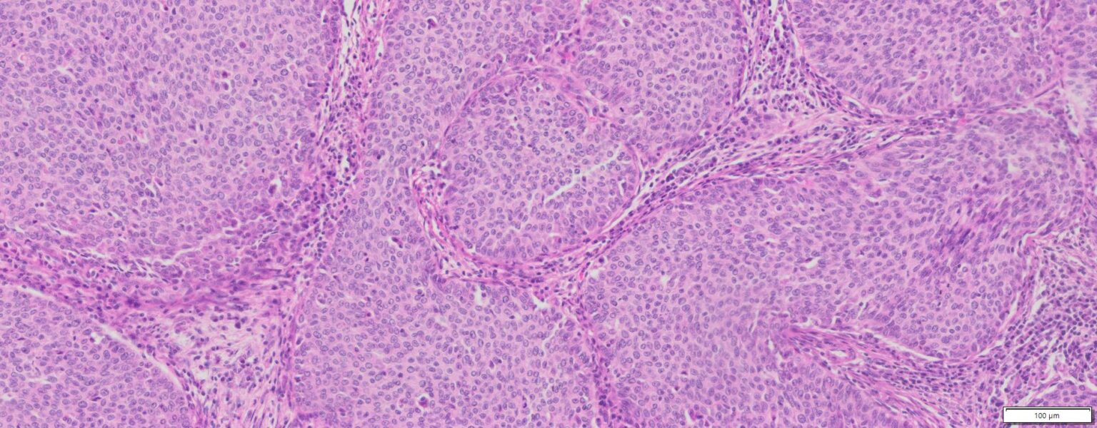 Human Cervical (Squamous Cell Carcinoma) FFPE Sections