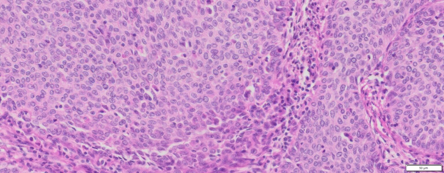 Human Cervical (Squamous Cell Carcinoma) FFPE Sections