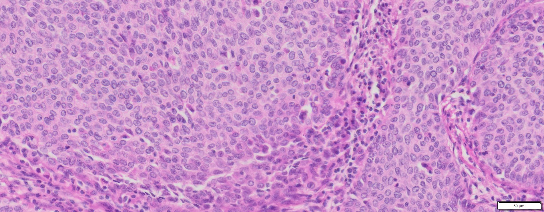 Human Cervical (Squamous Cell Carcinoma) FFPE Sections