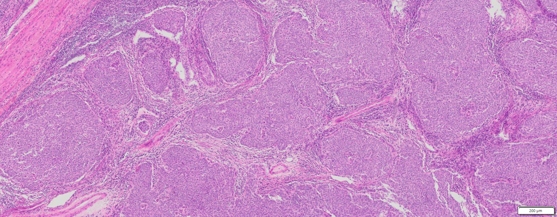 Human Cervical (Squamous Cell Carcinoma) FFPE Sections