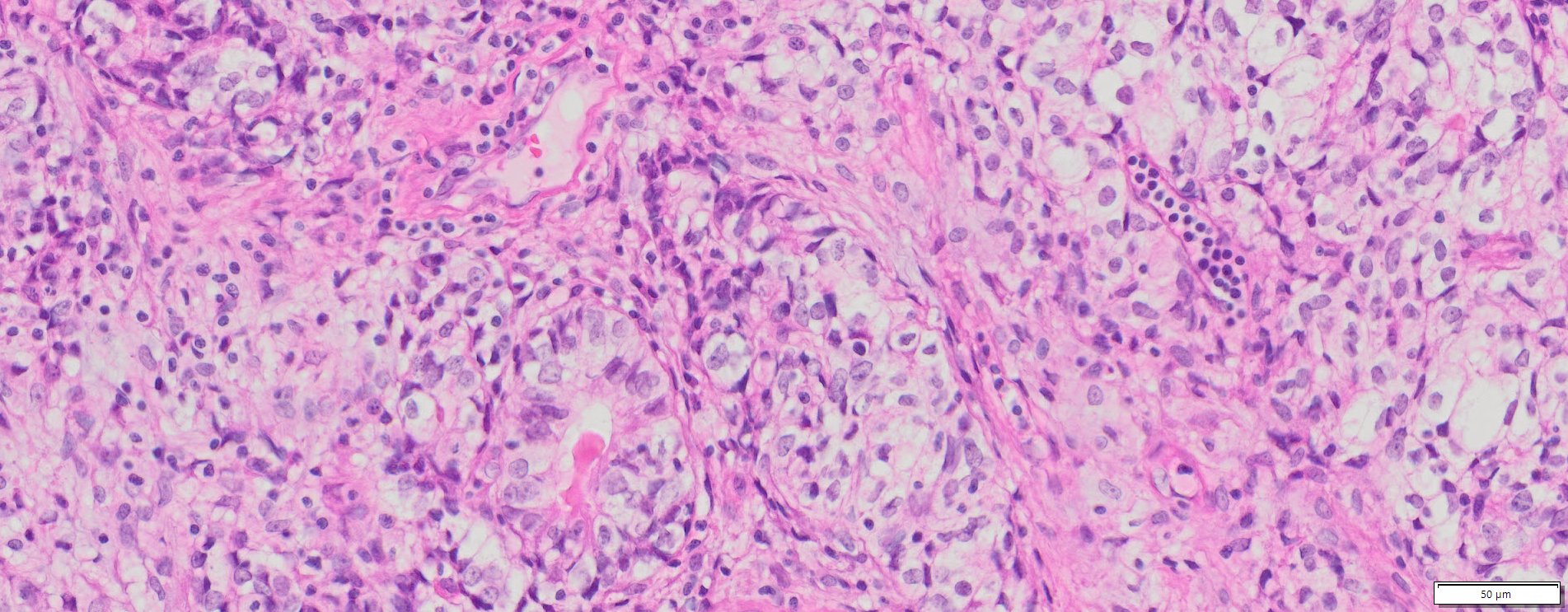 Human Endometrial Cancer (Carcinoma with squamous differentiation) FFPE ...