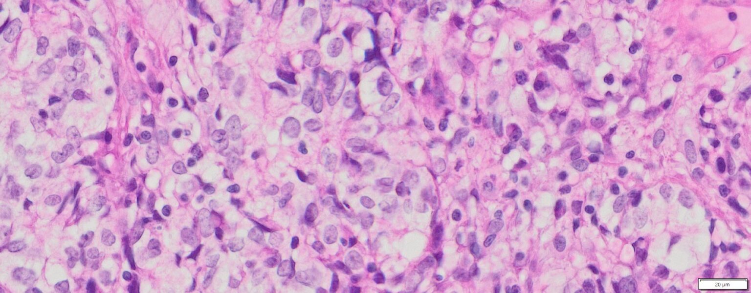 Human Endometrial Cancer (Carcinoma with squamous differentiation) FFPE ...