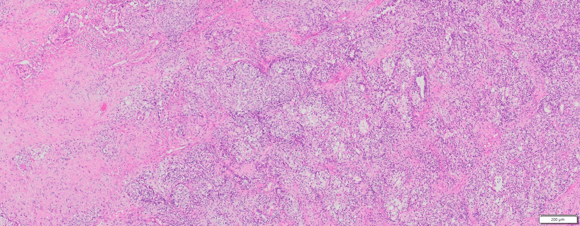 Human Endometrial Cancer (Carcinoma with squamous differentiation) FFPE ...