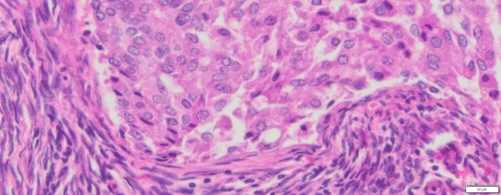 Human Endometrial Cancer FFPE Sections