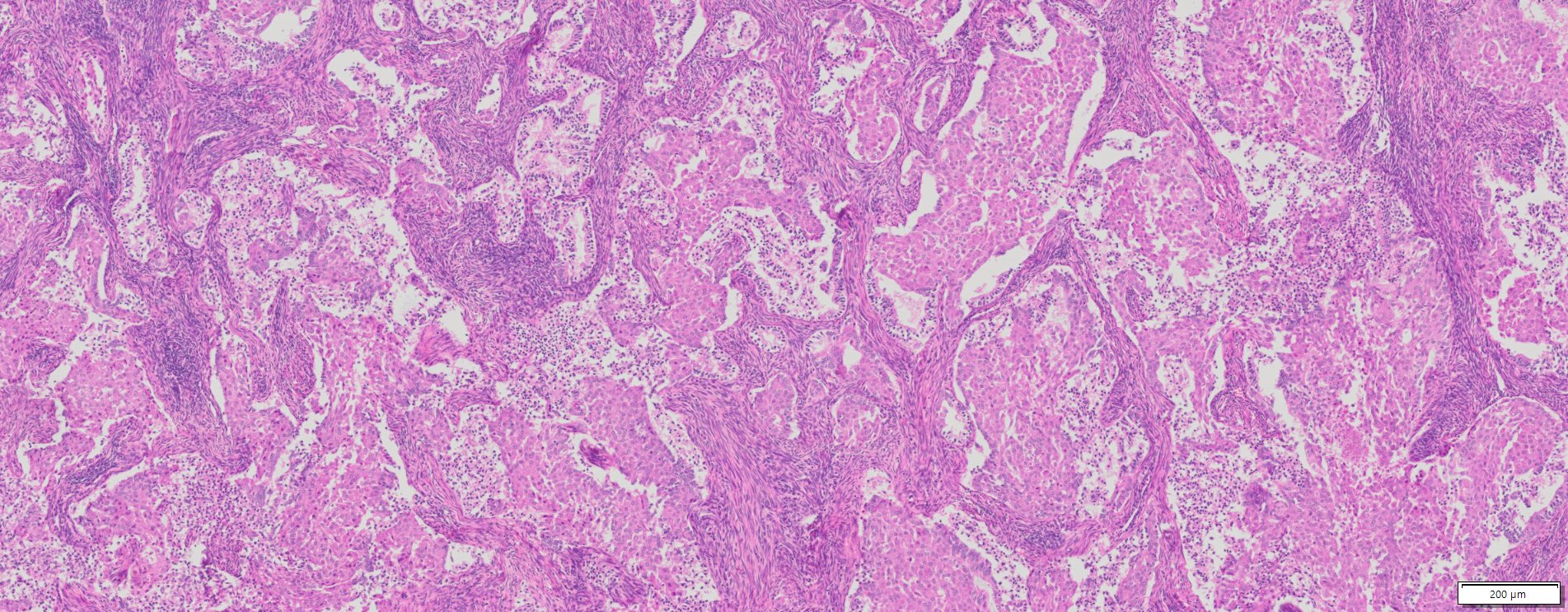 Human Endometrial Cancer FFPE Sections