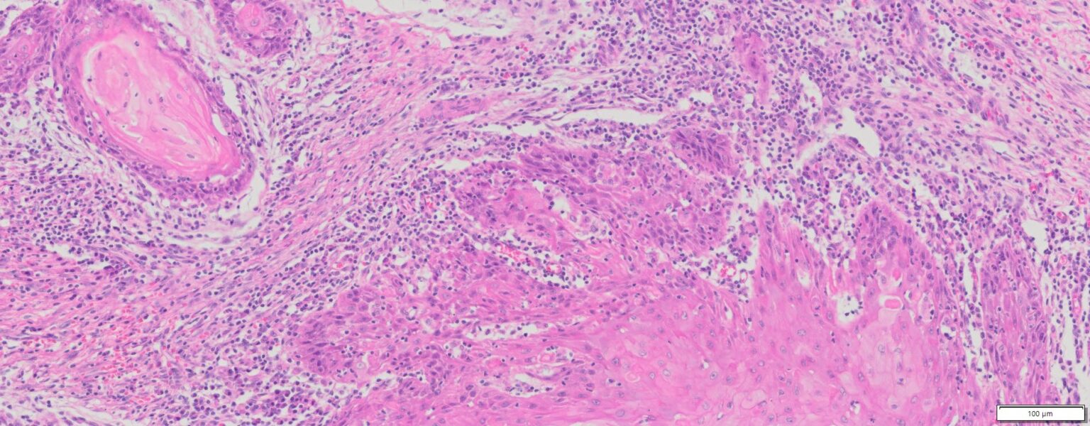 Human Endometrioid (Carcinoma with Squamous Differentiation) FFPE ...