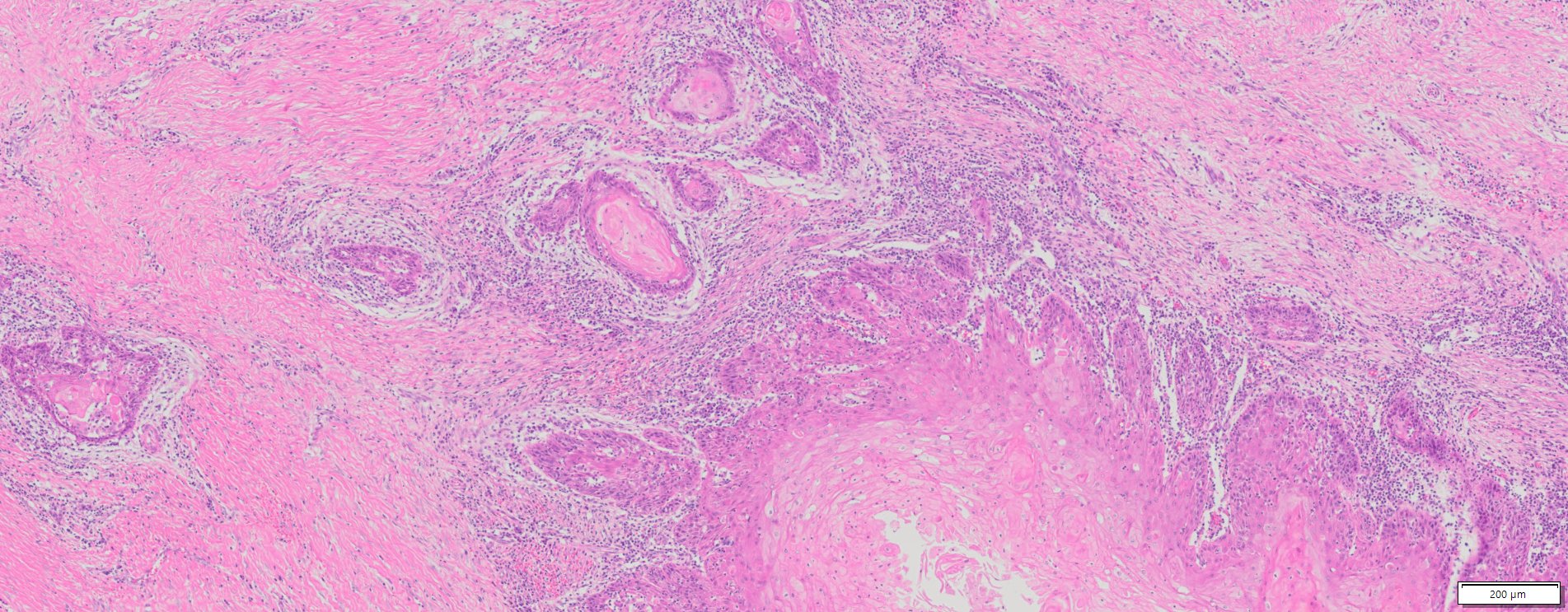 Human Endometrioid (Carcinoma with Squamous Differentiation) FFPE ...