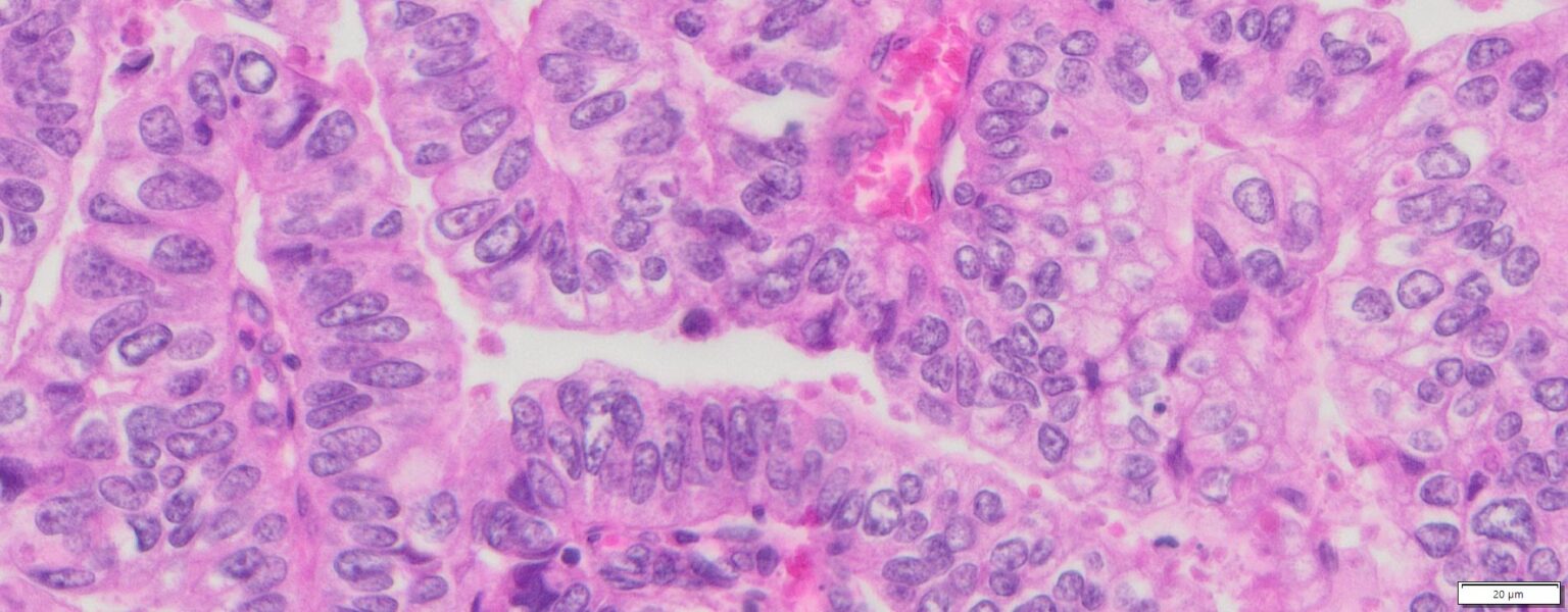 Human Endometrial Cancer FFPE Sections