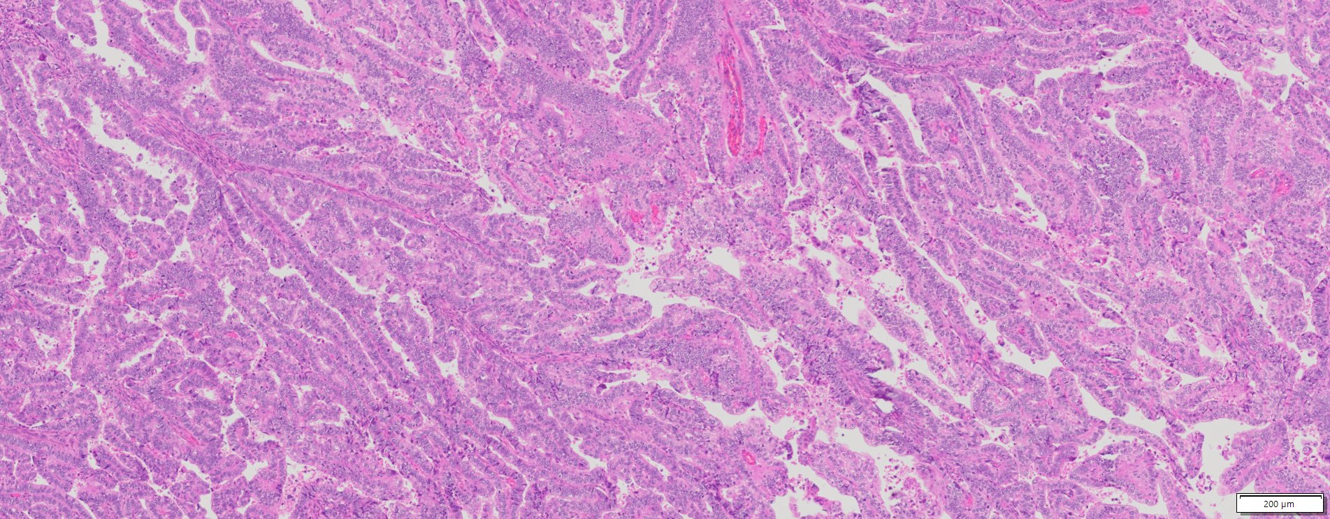 Human Endometrial Cancer FFPE Sections