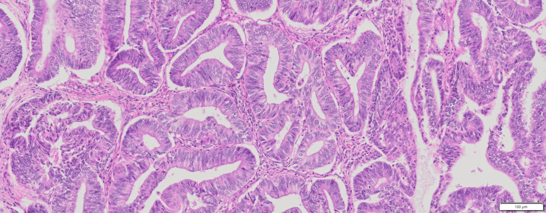 Human endometrioid (Adenocarcinoma of the endometrium) FFPE Sections